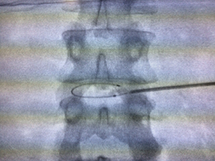 Anuloplastia - Ortopedia Sudoeste