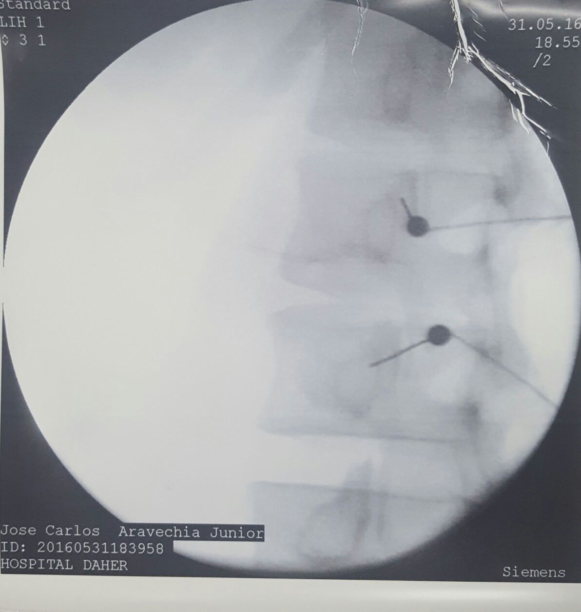 Rizotomia por Radiofrequência Lombar - Ortopedia Sudoeste